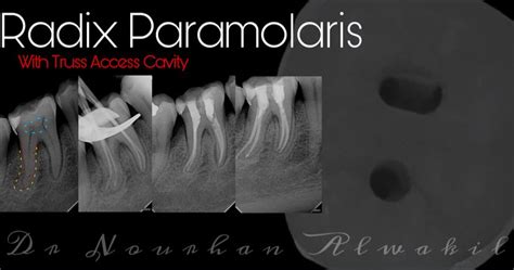 Nourhan Elwakil On Linkedin Radix Paramolaris Truss Access Endodontics Dentalpractice