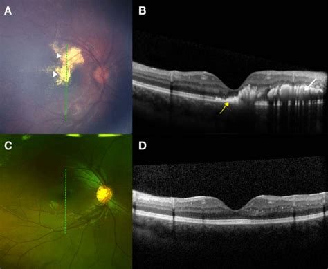 Evolution Of Bright Hyperreflectivities In Stage 2b Disease The Dotted