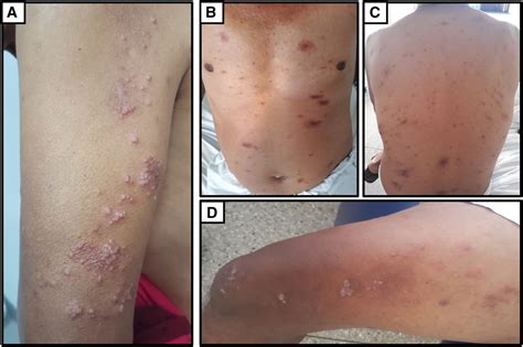 Diffuse Cutaneous Leishmaniasis