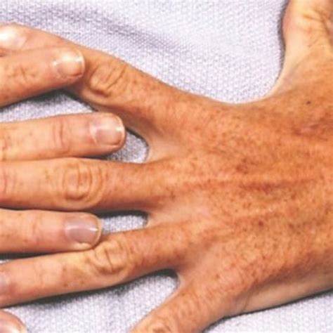 Does The Skin On Your Hands Match The Skin On Your Face