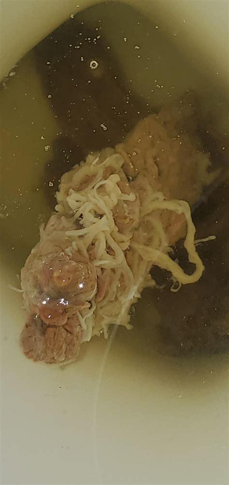 Stringy Mucus In Stool