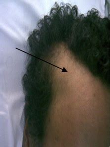 Right Scalp Swelling Cold Abscess Download Scientific Diagram