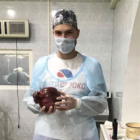 صورة توضح كيس على المبيض الأيسر25 Cm تم إكتشافه بشكل مفاجأ أثناء