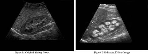 figure 1 from ultrasound image enhancement using discrete wavelet