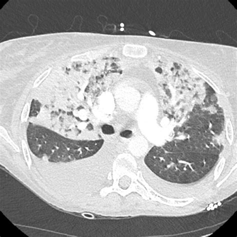 Computed Tomography Lung Image Demonstrating Bilateral Pleural