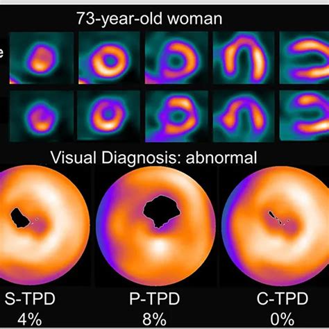 Stress MPI Myocardial Perfusion Imaging Test Price In Delhi India Ganesh Diagnostic