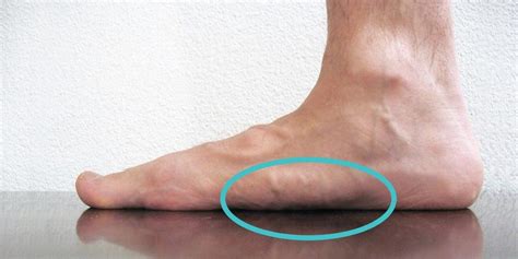 Posterior Tibial Tendon Dysfunction Overview Artofit