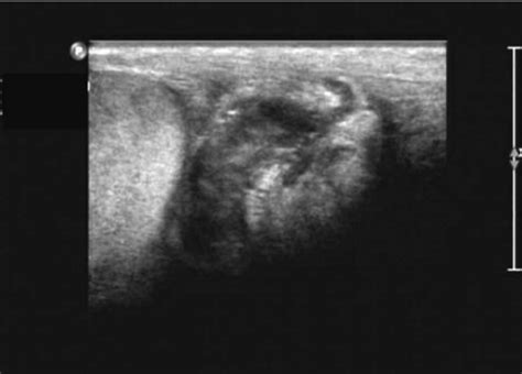Gray Scale Ultrasonography Of Epididymal Tale Longitudi Nal Scan Download Scientific