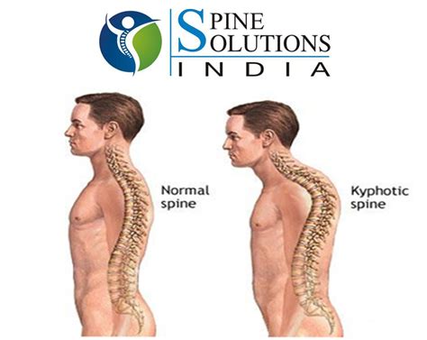 Kyphosis Unusual Curvature Of The Spine