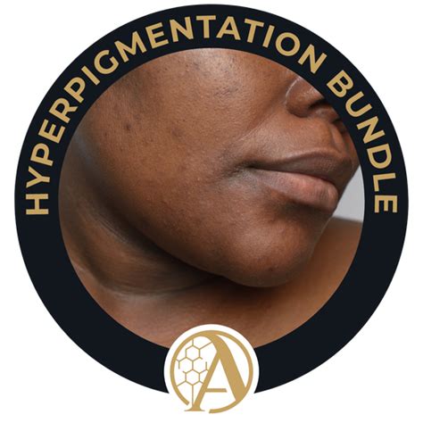 Hyperpigmentation Amaka Skin Science