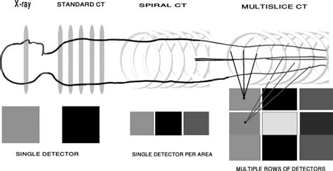 Illustration Showing The Difference Between X Ray Standard Ct Helical