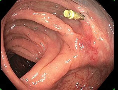 A 15 Mm Subepithelial Vascular Lesion At The Hepatic Flexure Download Scientific Diagram