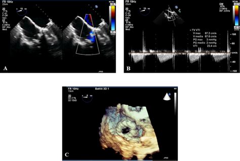 The 3d Transesophageal Echocardiography Tee Post Procedure Shows The Download Scientific