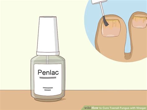 How To Cure Toenail Fungus Can Vinegar Help
