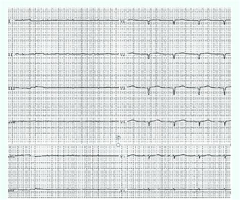 Electrocardiograma De 12 Derivaciones Evolutivo Download Scientific