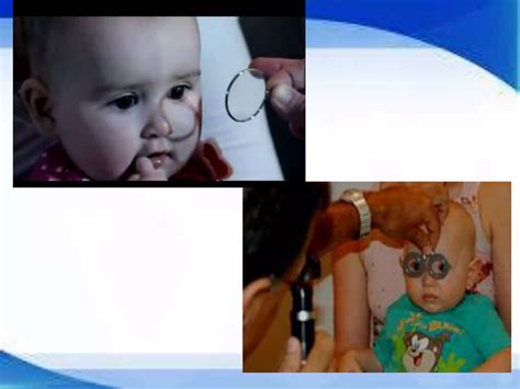 Dynamic Retinoscopy Pptx