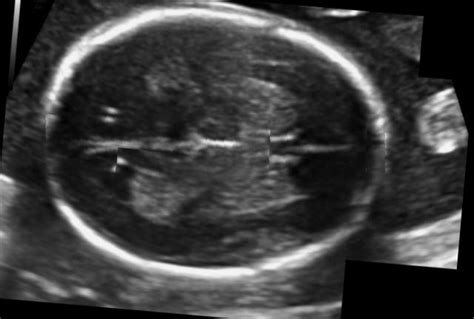 Medical Image Augmentation Semantic Segmentation Model By Fetal