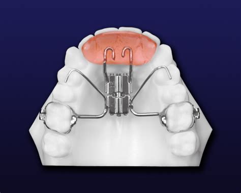 Fixed Appliances Stoller Dental Lab