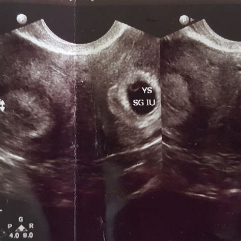 2d Ultrasound Image Of A Bicornuate Uterus With An Intra Uterine