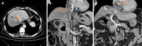 Abdominal Contrast Enhanced Computed Tomography At 1 5 Years After Download Scientific Diagram