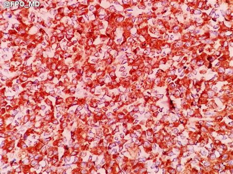 Myeloid Sarcoma Myeloperoxidase