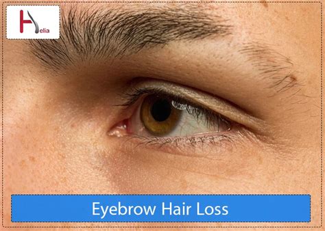 Eyebrow Transplantation Archives Helia Clinic