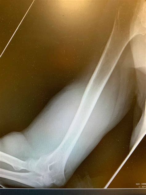 Upper Extremity Hematoma An Atypical Case Of Compartment Syndrome Pmc