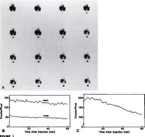 Figure 1 From Comparison Of Technetium 99m Mibi And Thallium 201 Chloride Myocardial