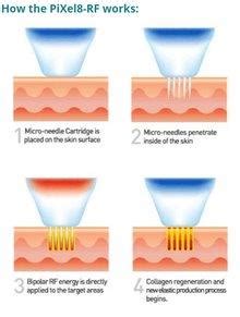 Pixel8 Rf Micro Needling Lakes Cosmetic Institute