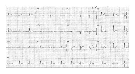 An Electrocardiogram Of A 32 Year Old Man With Left Sided Chest Pain