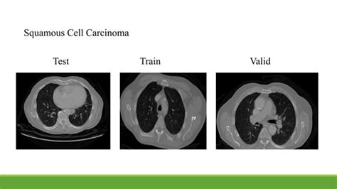 Detection Of Lung Cancer From Ct Images Using Svm Classification And Compare The Survival Rate