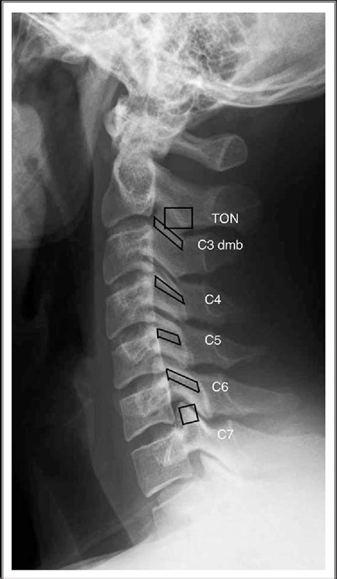 Cervical Medial Branch Block