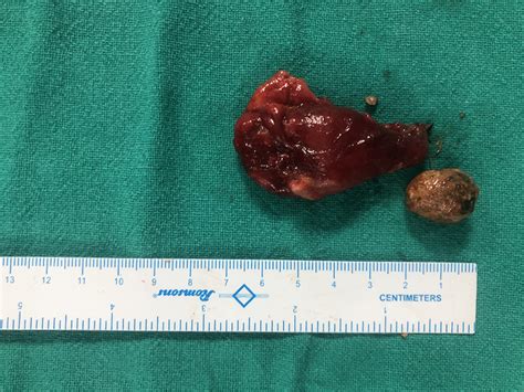 Case Of Giant Appendicolith A Common Ailment With A Rare Finding Thapa 2023 Clinical Case