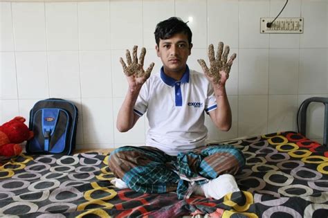 مرد درختی پس از جراحی های فراوان توانست دوباره دخترش را در آغوش بگیرد