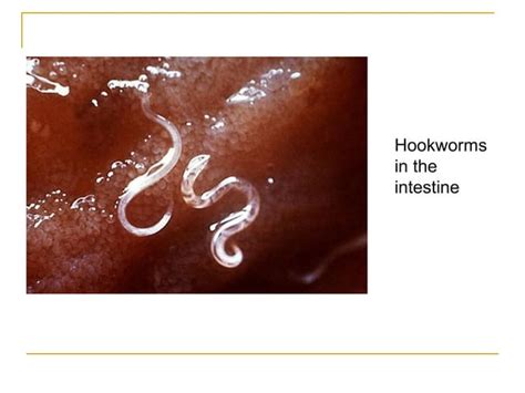 Ancylostomiasis Ppt Infectious Diseases Diseases And Conditions