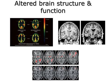 Ppt Discovering Disease Genes The Example Of Schizophrenia Powerpoint Presentation Id295795