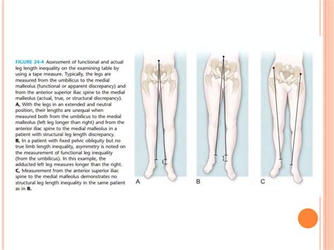 Limb Length Discrepancy Pptx