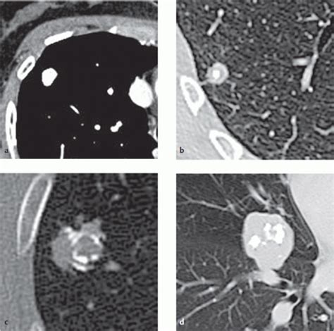 Pulmonary Nodules Radiology Key