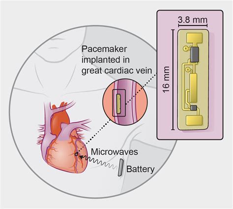 New Wireless Pacemaker Could Prevent Common Complications Scientific American