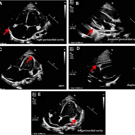 Echocardiography On Admission Showed Pericardial Effusion A