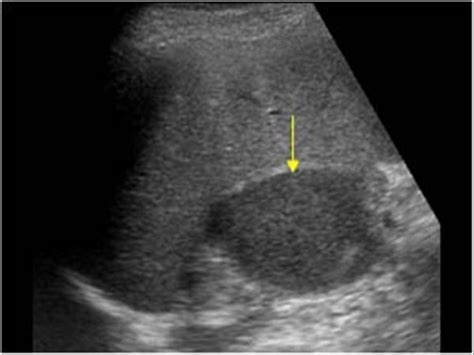 Abdomen And Retroperitoneum 14 Spleen Case 141 Cysts And