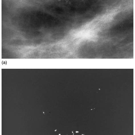 An Example Of A Cluster Of Malignant Microcalcifications In The Data