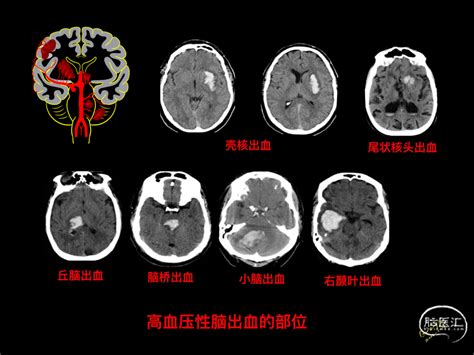 头颅 Mr、ct 临床实用「影像征」（一） 脑医汇