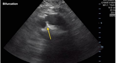 Bilateral Common Iliac Artery Aneurysm Jetem