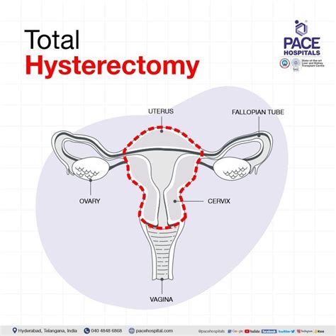 Hysterectomy Surgery In Hyderabad Indications Side Effects And Cost