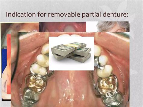 Removable Partial Denture Pptx