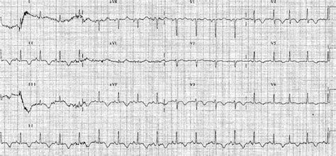 Monophasic Action Potential Like Ecg In A Patient With Renal Download Scientific Diagram