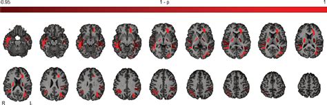 Figure 4 From Association Between Structural Brain Mri Abnormalities And Epilepsy In Older