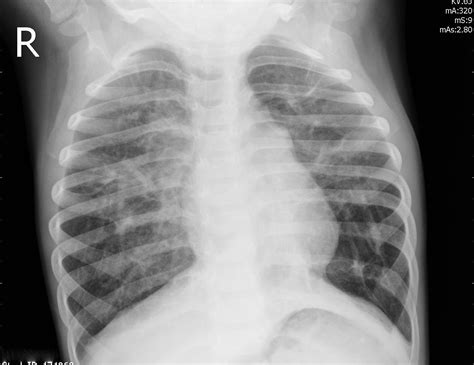 Azraahmadi Autotrain Data Xray Dataset · Datasets At Hugging Face