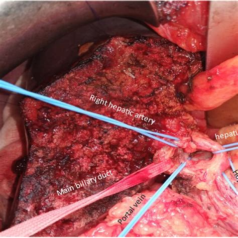 Bisegmentectomy Ivb V With Extensive Lymph Node Dissection Download